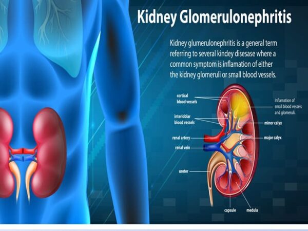 Glomerulonephritis - Knowing about It Is Important