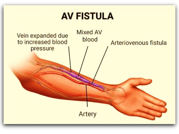 How to Keep Your Fistula Working for Long
